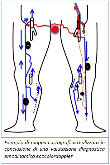 Insufficienza venosa degli arti inferiori - Haemodynamicsdelfrate ...